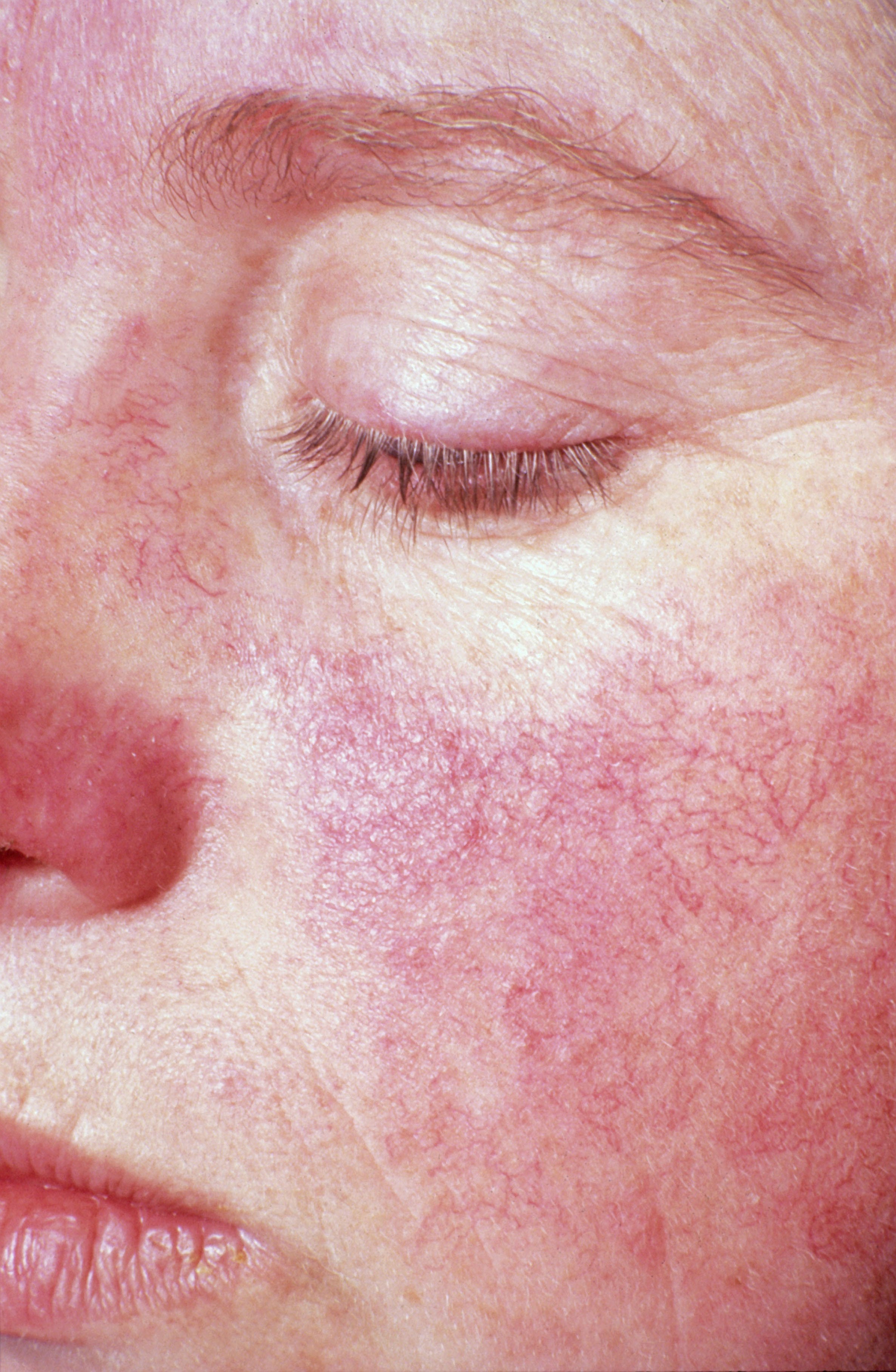 Lupus Rashes All About Lupus Rashes Kulturaupice