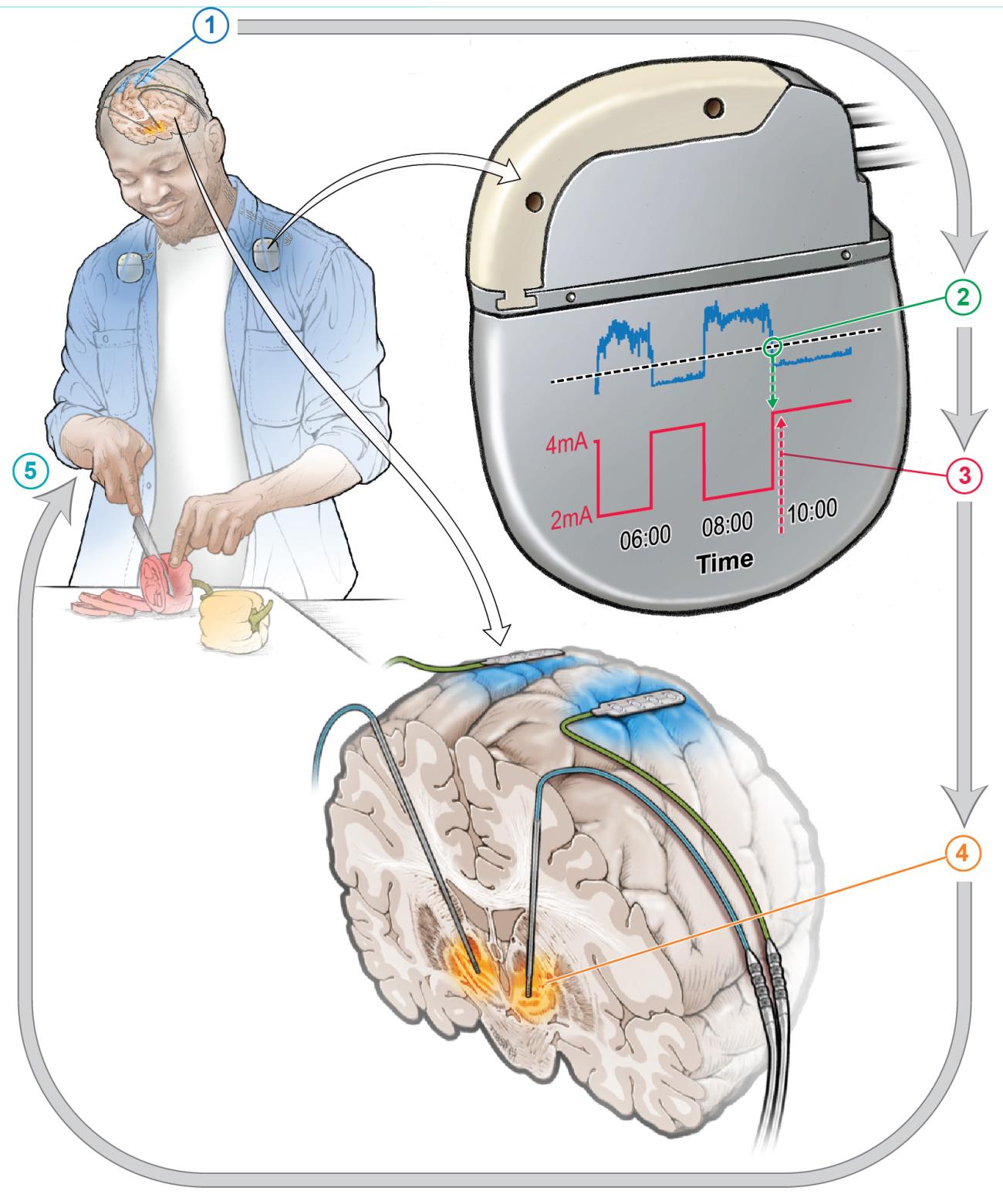 Self-adjusting brain pacemaker may help reduce Parkinson’s disease ...
