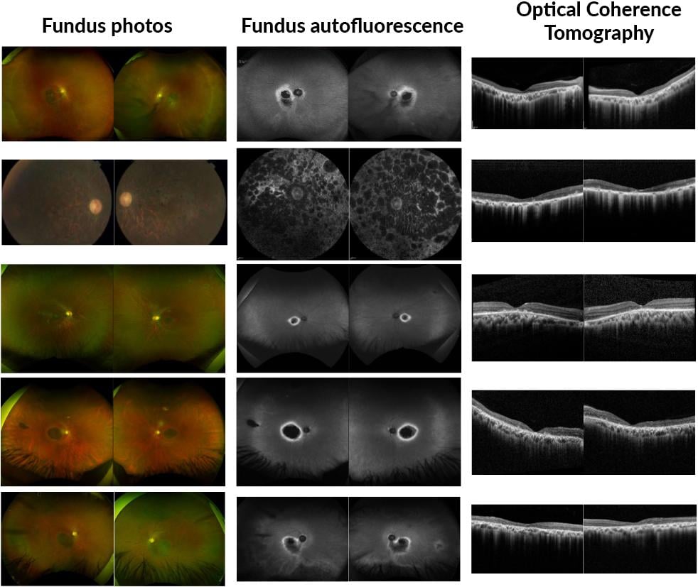 Scientists discover gene responsible for rare, inherited eye disease ...