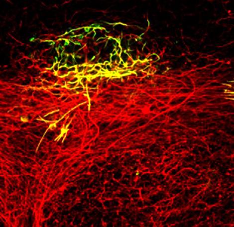 Scientists discover roadblocks that stop brain white matter healing ...