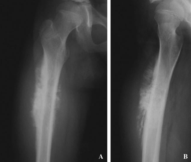 NIH study provides genetic insights into osteosarcoma in children ...