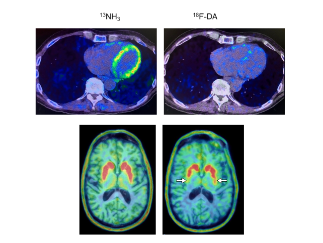 PET scans may predict Parkinson’s disease and Lewy body dementia in at ...