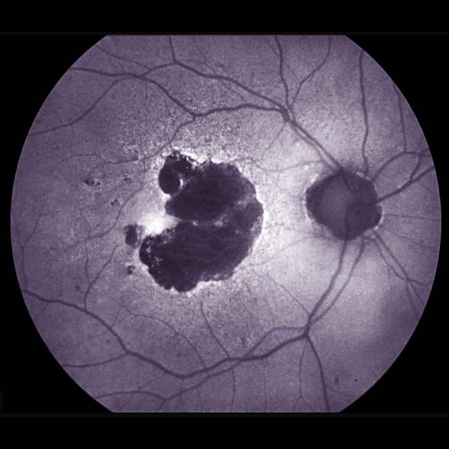 Inflammation-reducing drug shows no benefit for dry age-related macular ...