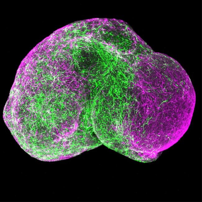 Study suggests approach for treating rare disorder | National ...